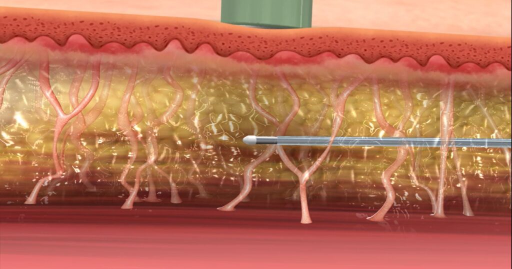 AccuTite | Skin Contouring by WHOW Aesthetics